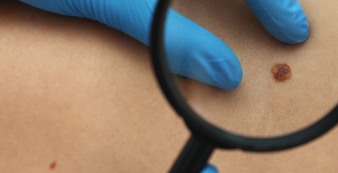 Tumor benigno: qué es y por qué se forma - Blog de Occident